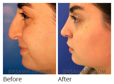 Female Rhinoplasty Gallery | Before & After Nose Job