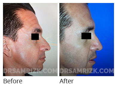 Rhinoplasty Before And After | Nose Job Gallery
